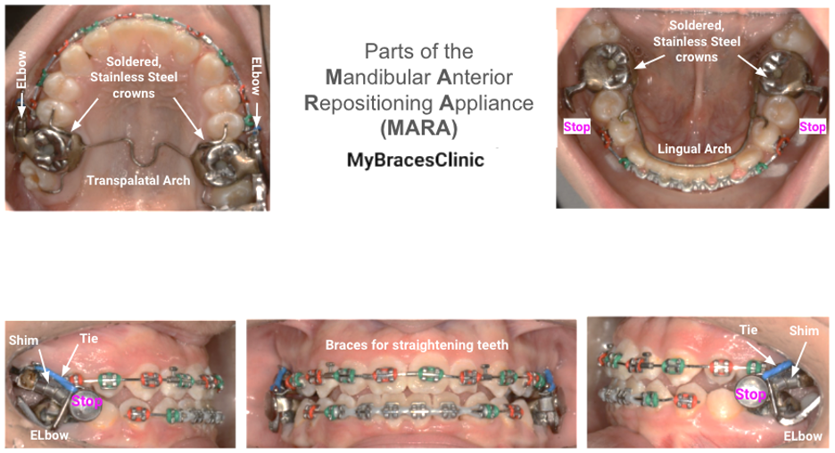 Mandibular Anterior Repositioning Appliance (MARA) - MyBracesClinic