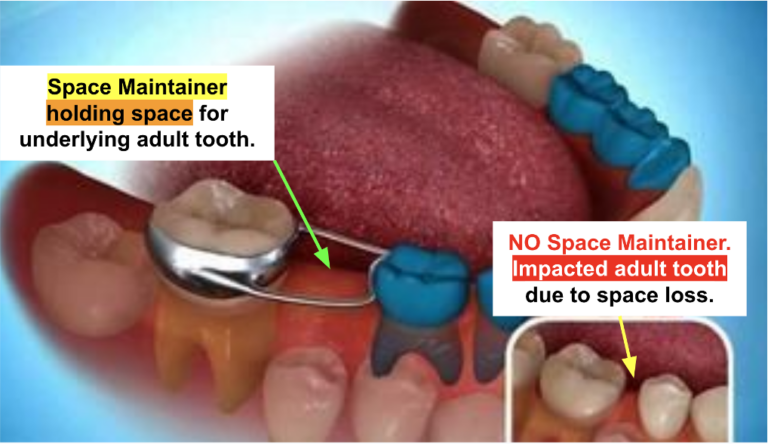 Space Maintainers | Space Preservation - MyBracesClinic