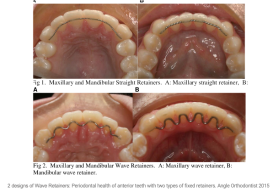 Types of Orthodontic Retainers - MyBracesClinic