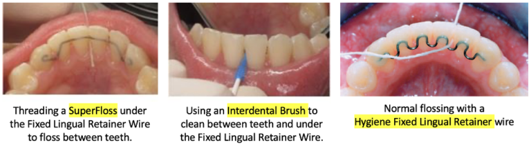 Retainer Instructions - MyBracesClinic
