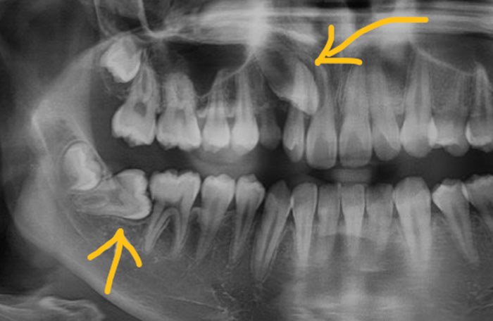 Tracking Impacted Teeth - MyBracesClinic