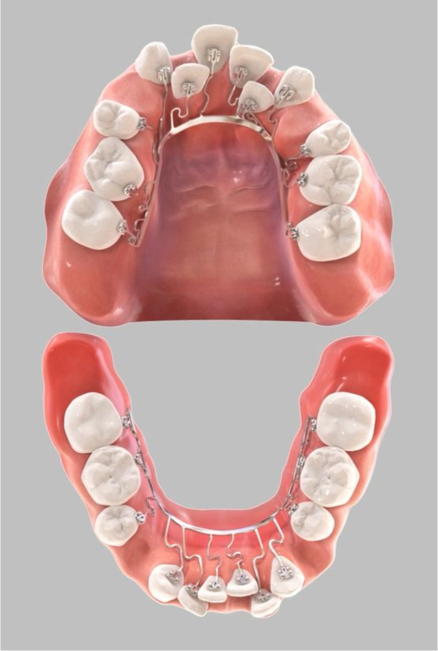 Brava Lingual Braces - MyBracesClinic
