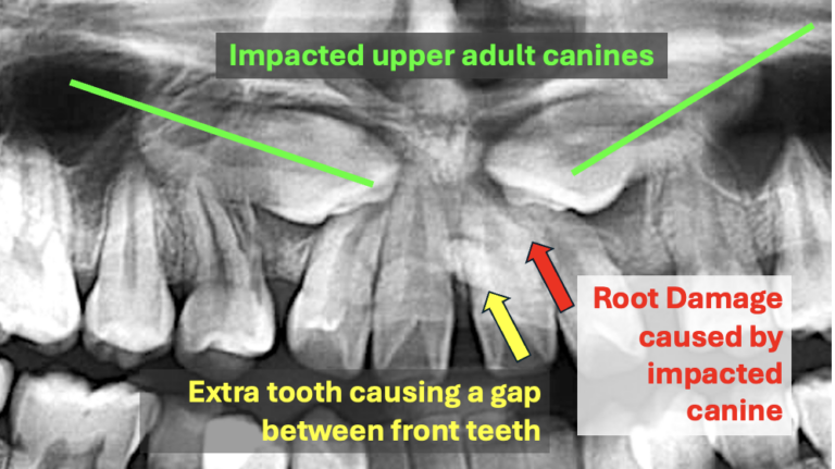 Tracking Impacted Teeth | Stuck Teeth - MyBracesClinic