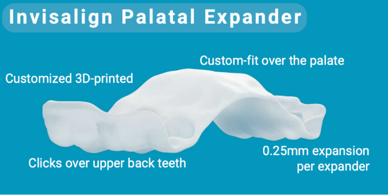 Palatal Expanders | Expansion - MyBracesClinic