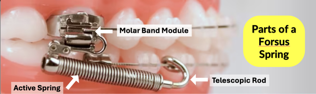 A complete guide to Forsus Spring for 'overbite' correction ...