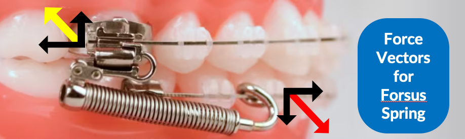 A complete guide to Forsus Spring for 'overbite' correction ...