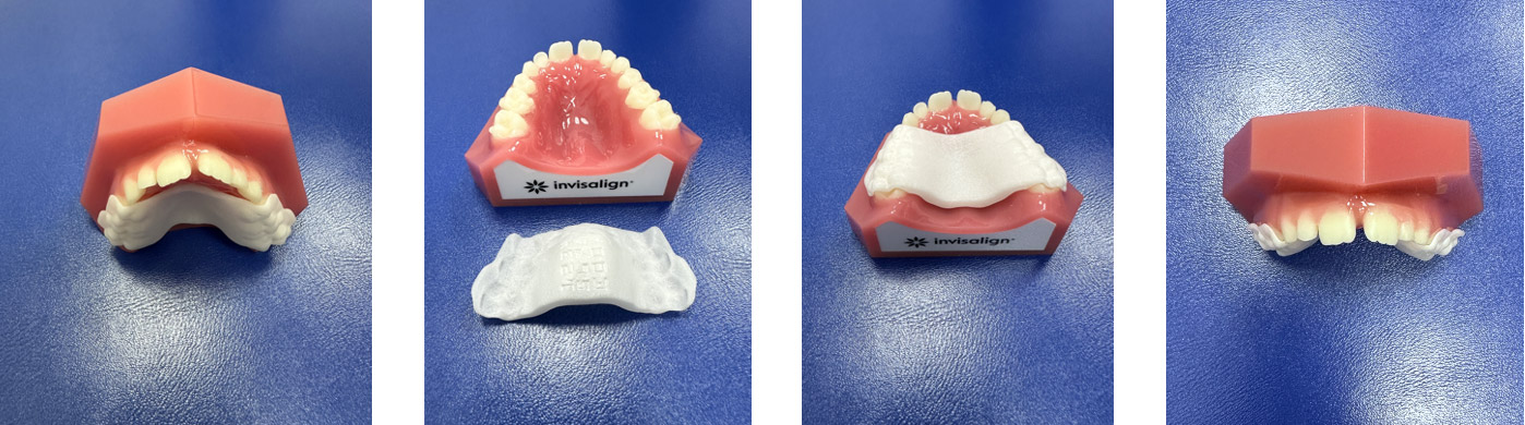 Invisalign Palatal Expander | Invisalign In Singapore - A Complete Guide
