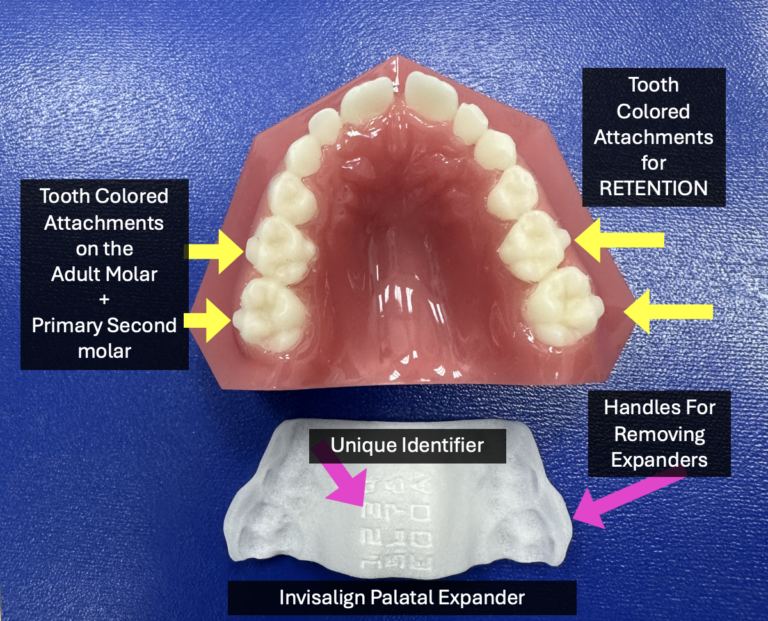 Invisalign Palatal Expander | Invisalign In Singapore - A Complete Guide