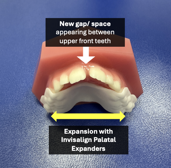 How to wear Invisalign Palatal Expander | Invisalign In Singapore - A ...