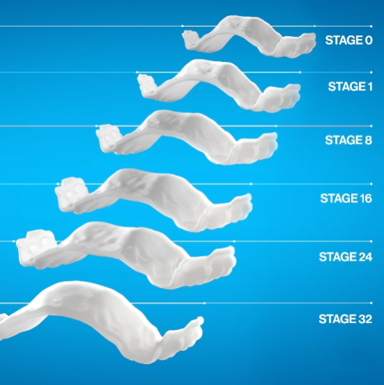 Invisalign Palatal Expander | Invisalign In Singapore - A Complete Guide