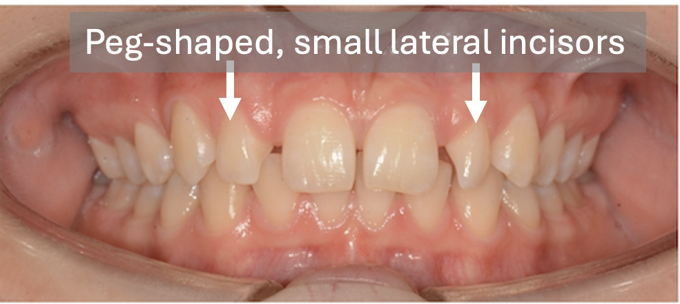 What is a Bolton's Discrepancy? - MyBracesClinic