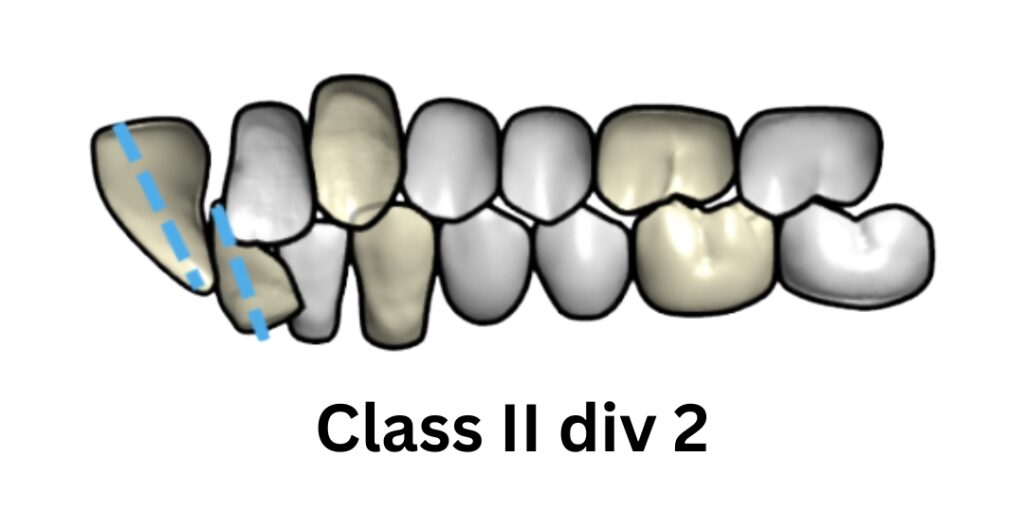 Invisalign Mandibular Advancement for Class II Correction