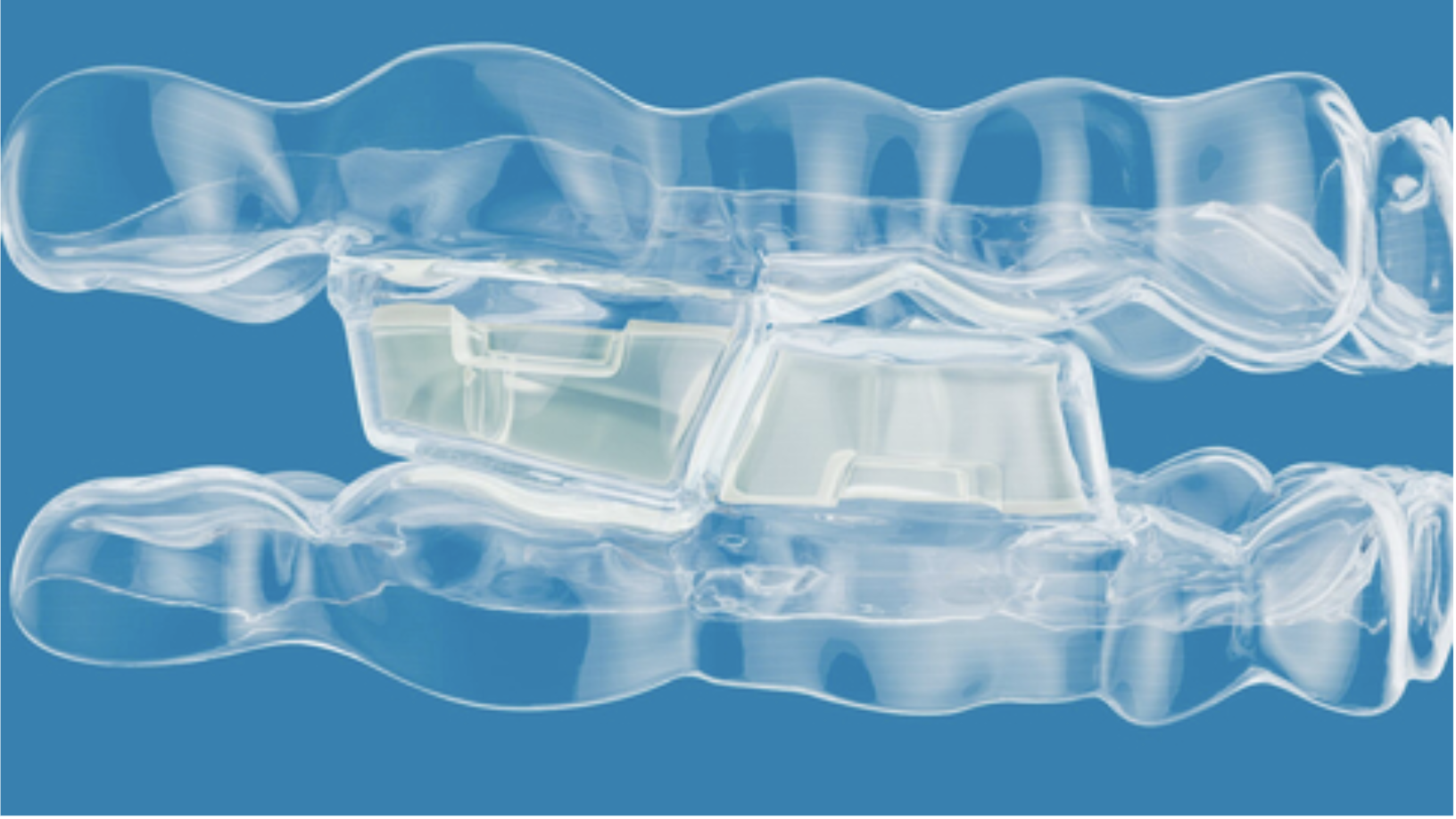 Invisalign Mandibular Advancement for Class II Correction