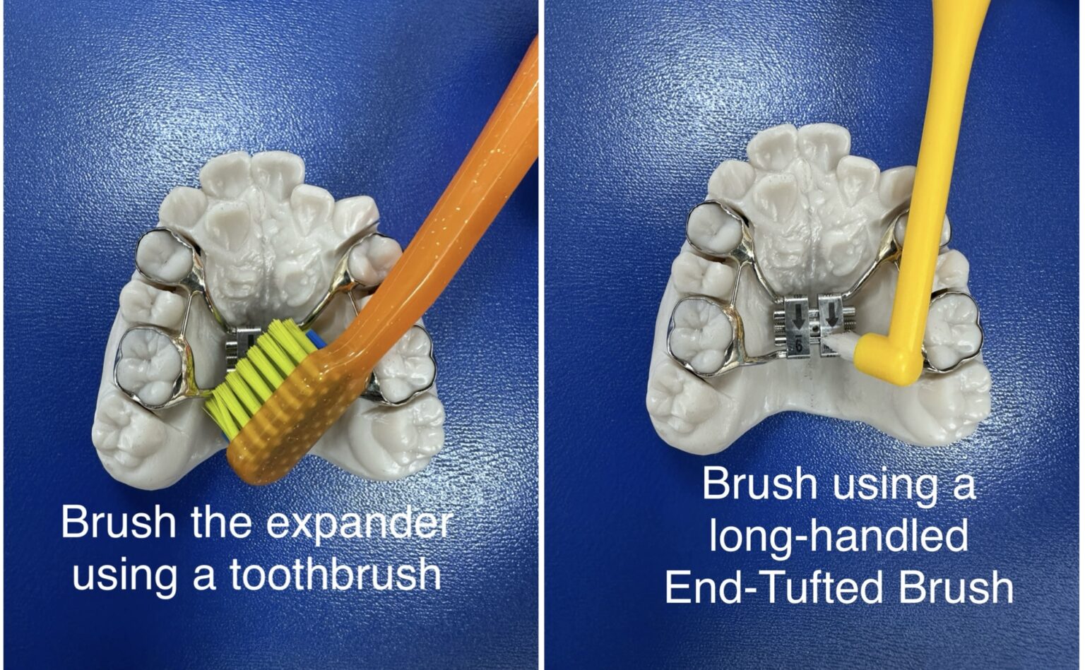 Fixed Palatal Expander Care | Expansion For Teenager - MyBracesClinic