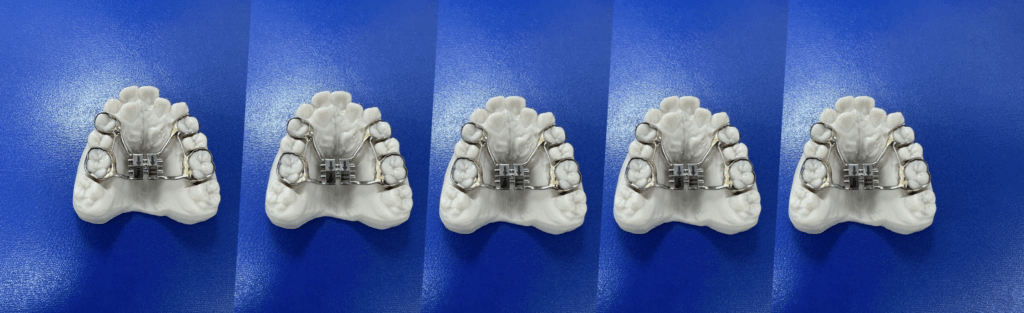 Fixed Palatal Expander Care | Expansion For Teenager - MyBracesClinic